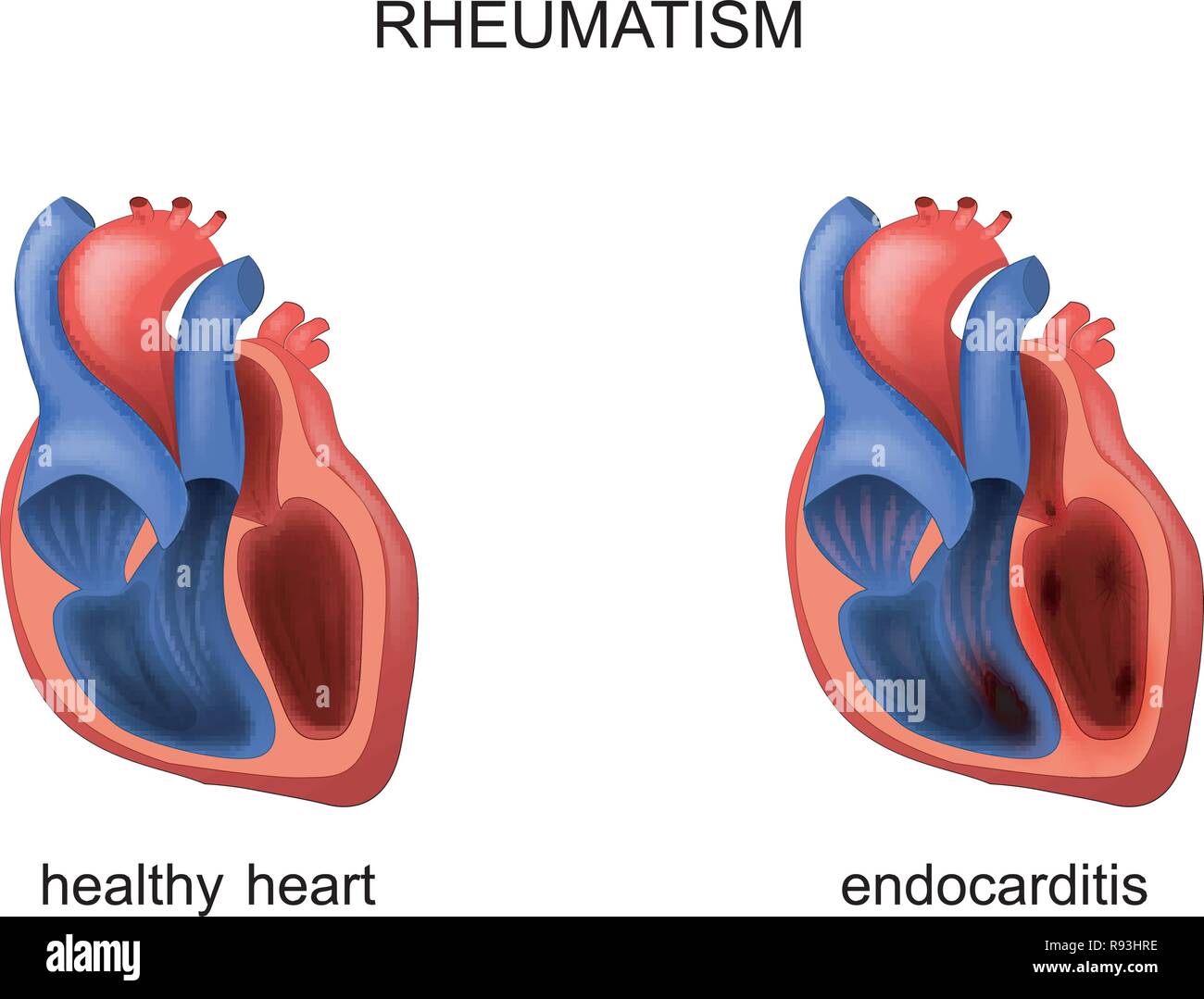 Vectores de endocarditis vector Banque de photographies et d’images à ...