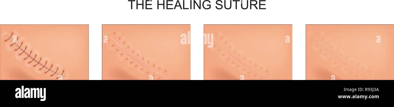 Points de suture chirurgie Banque d'images vectorielles - Alamy