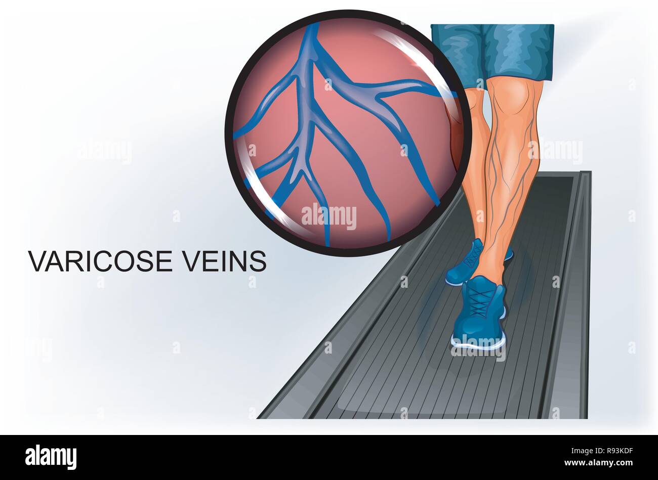 Varicose veins feet Banque d'images vectorielles - Alamy