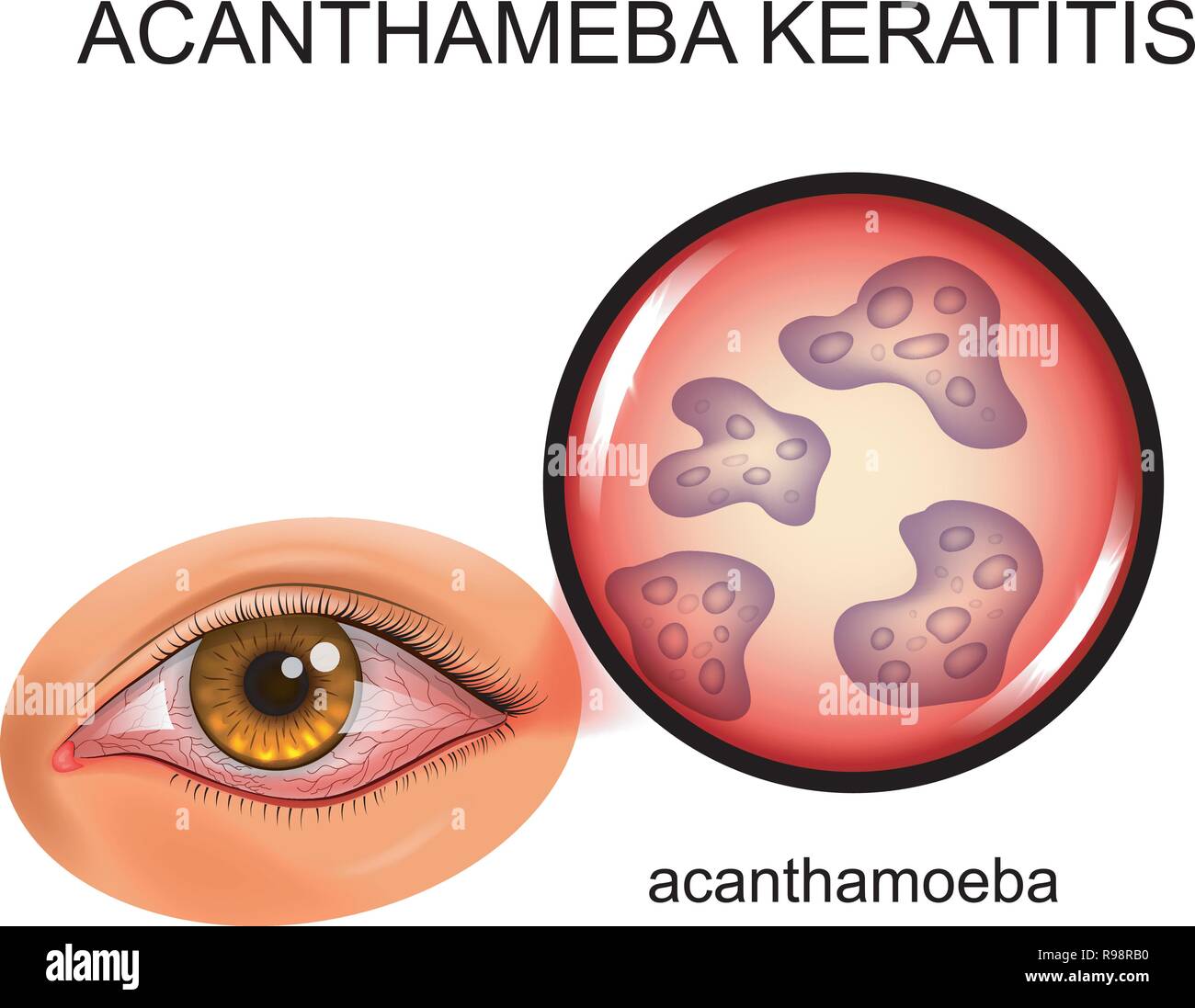 Kératite virale Banque de photographies et d’images à haute résolution ...