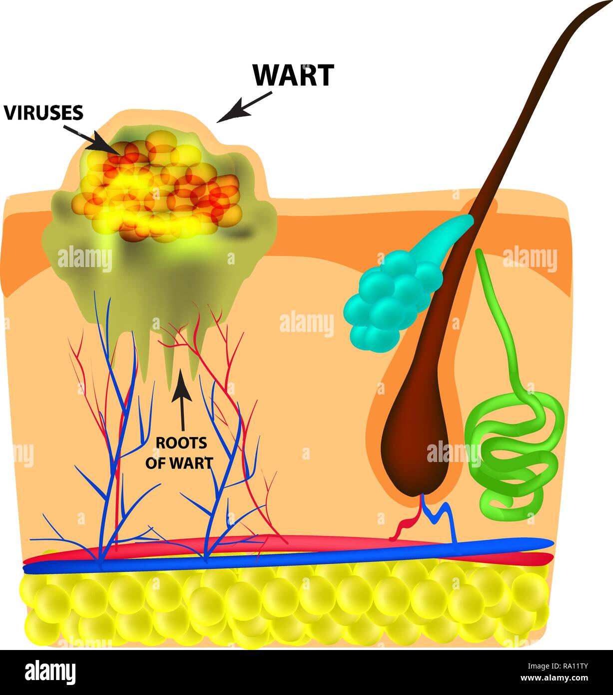 La structure de la verrue. La structure de la peau. L'infographie ...