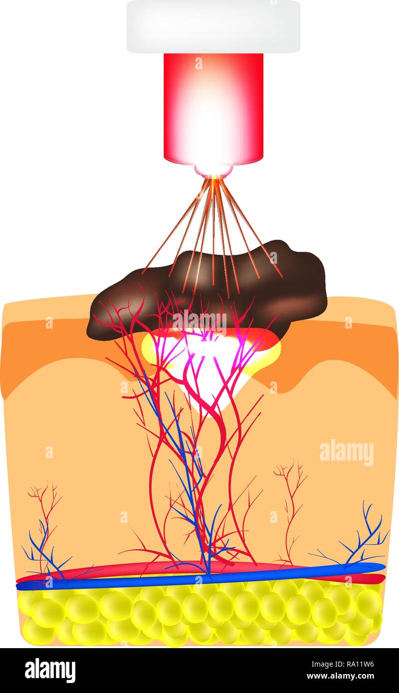 Suppression des taches, popiloma, verrue laser. La structure des grains ...