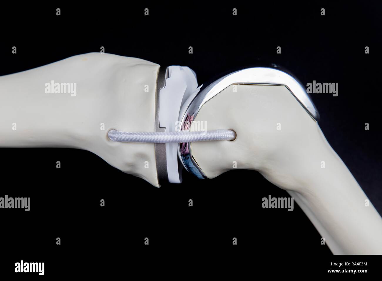 Prothèse du genou, genou endoprothèse ou du genou prothèse, sur un ...