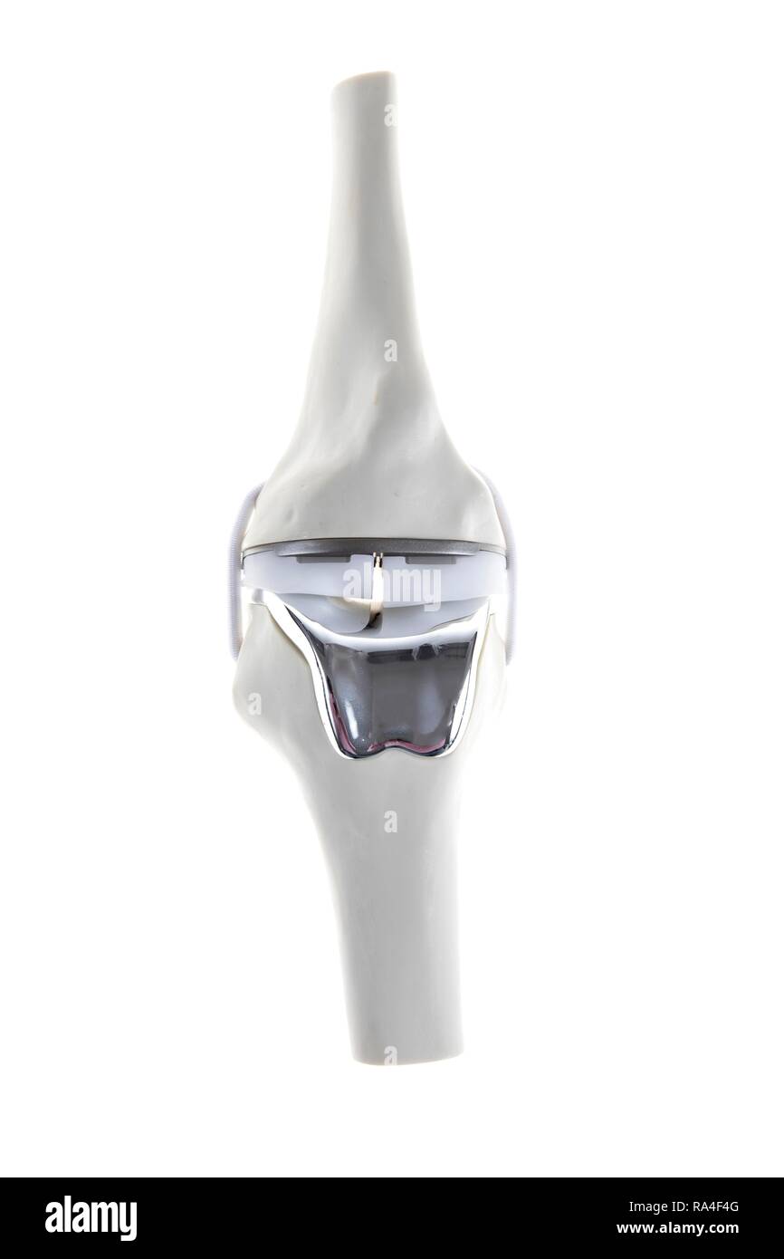 Prothèse du genou, genou endoprothèse ou du genou prothèse, sur un ...