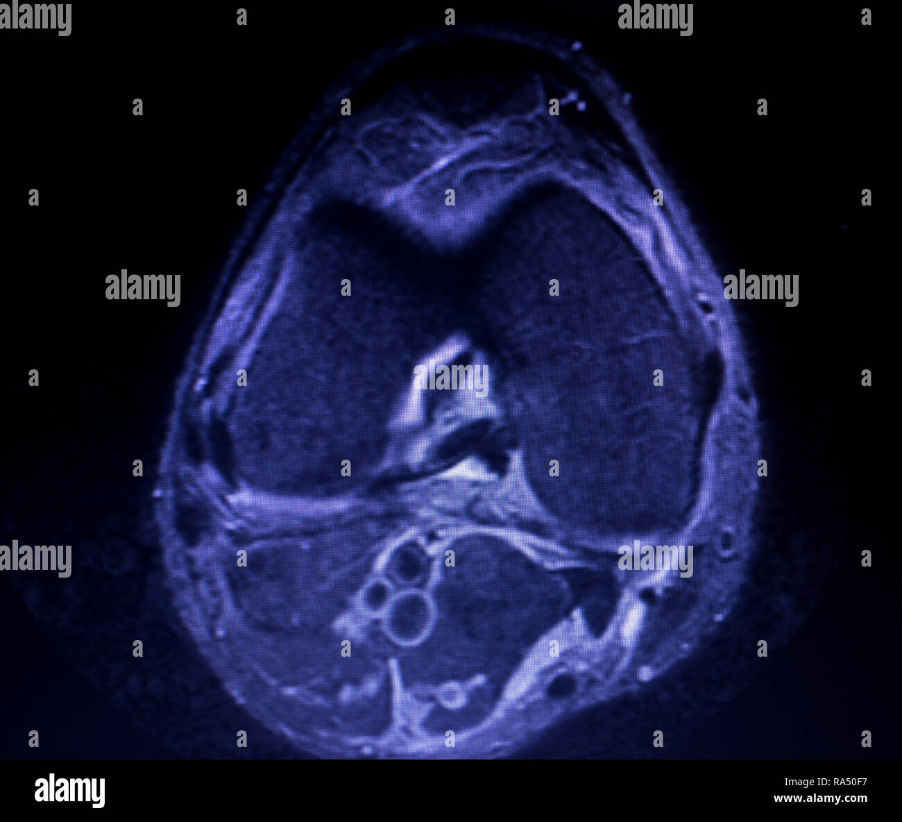 Mri knee Banque de photographies et d’images à haute résolution - Alamy