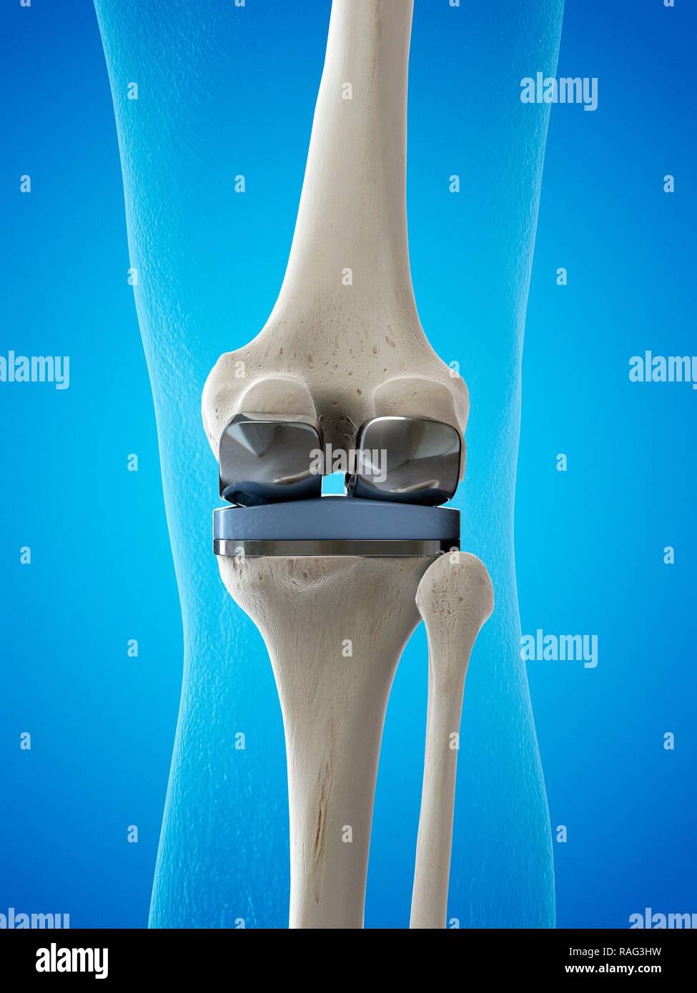 Illustration d'un remplacement du genou Photo Stock - Alamy