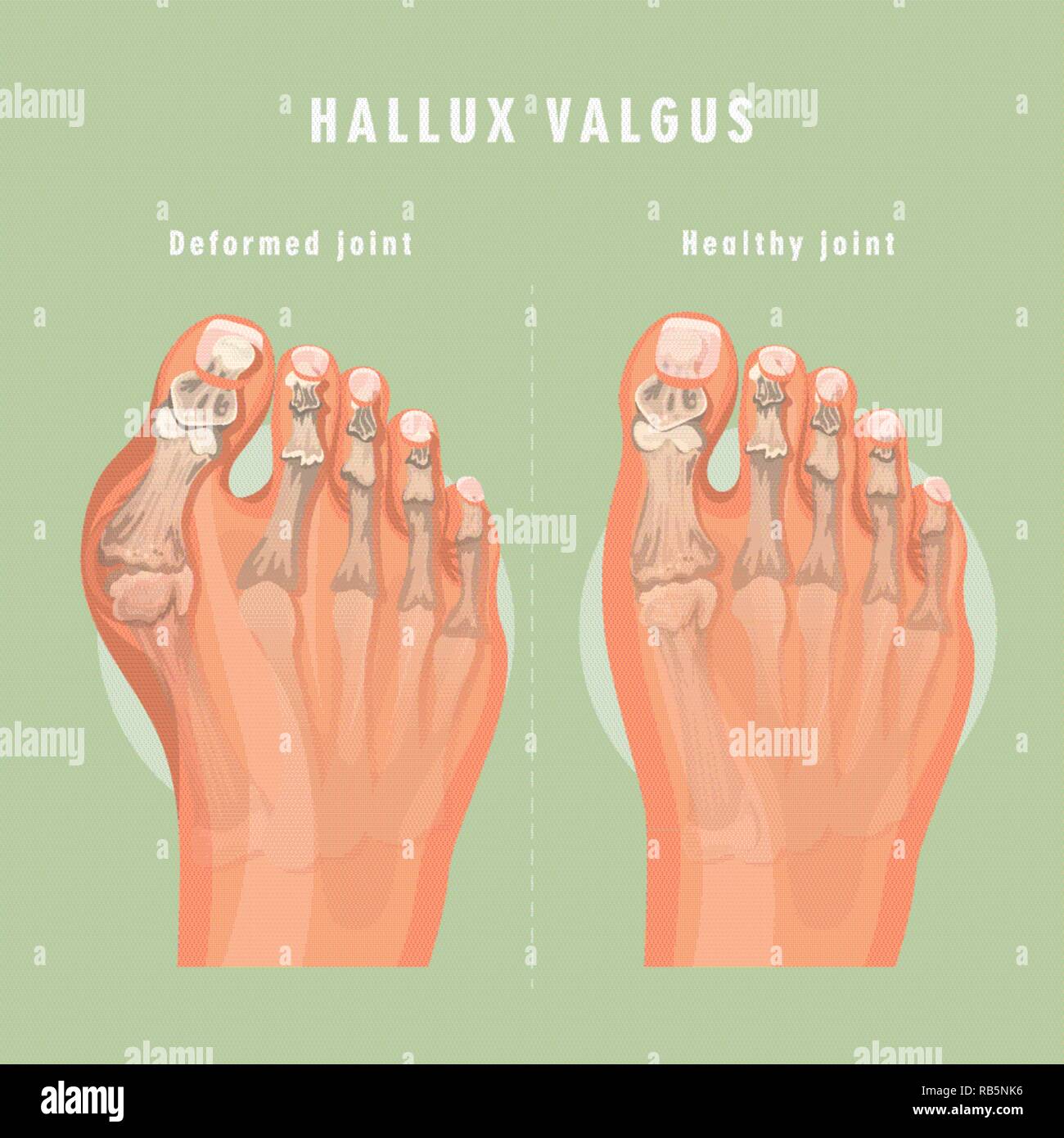 Anatomie Pied Valgus Banque d'images vectorielles - Alamy