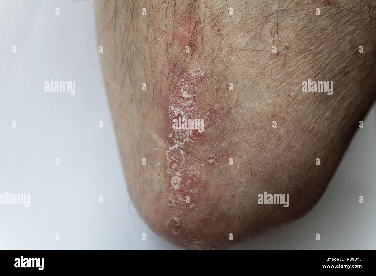 Détail du psoriasis Banque de photographies et d’images à haute ...