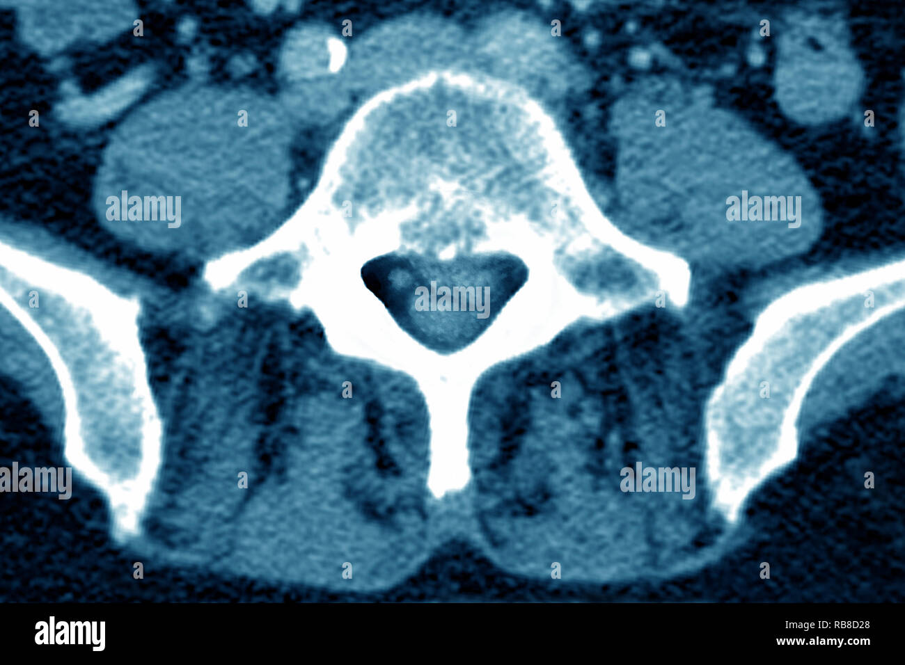 Syndrome de queue de cheval Photo Stock - Alamy