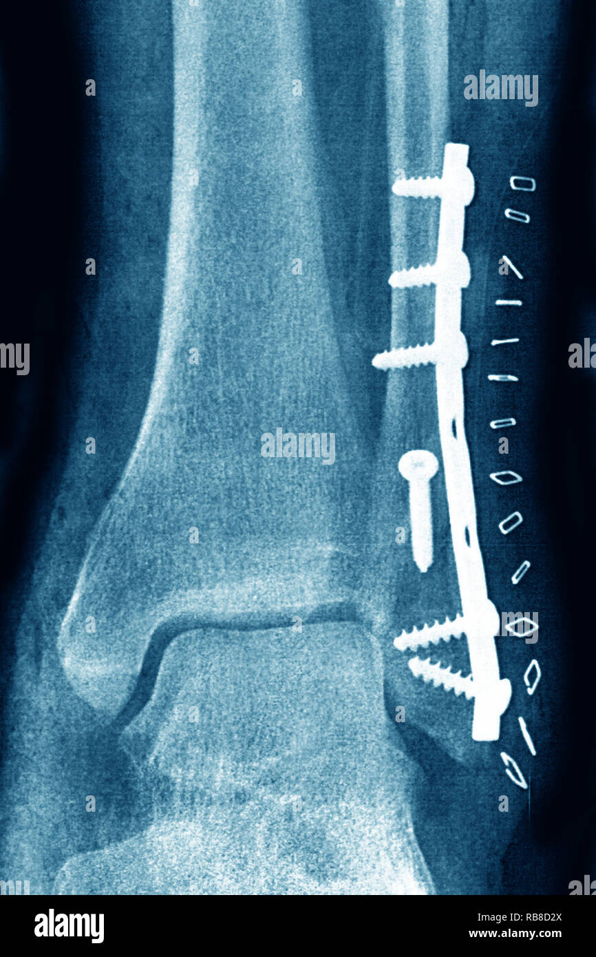 Fracture Of Tibia And Fibula Banque d'image et photos - Alamy