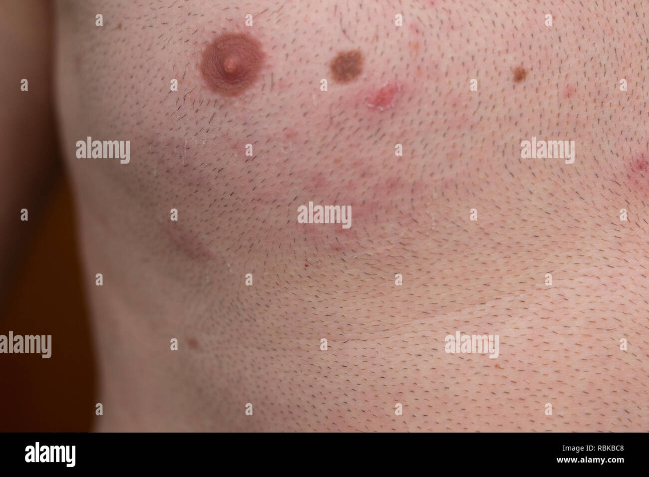 Maladie du zona Banque de photographies et d’images à haute résolution ...