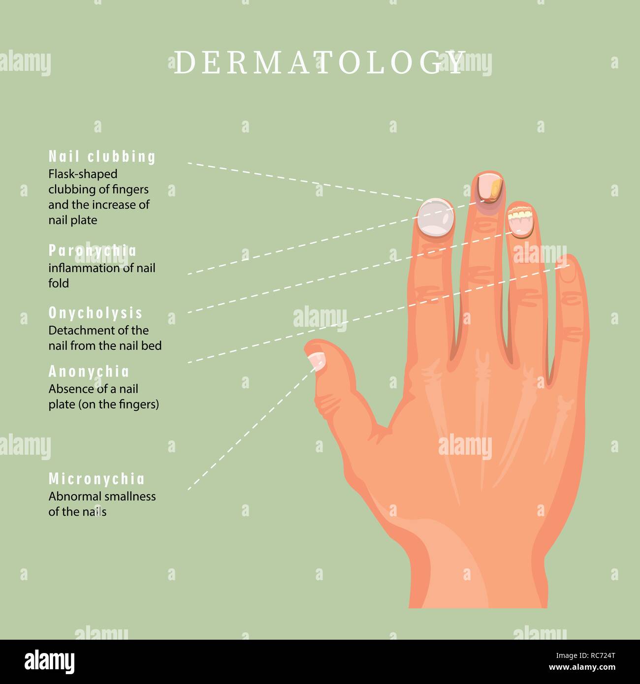 Panaris Doigt Banque d'image et photos - Alamy