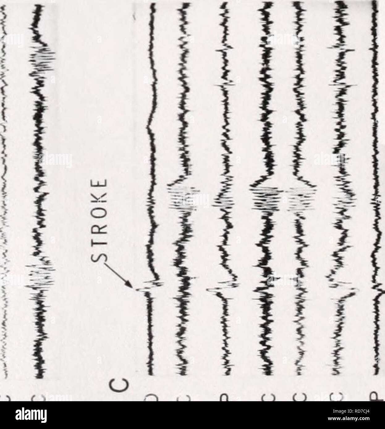 Syndrome de y Banque de photographies et d’images à haute résolution - Alamy