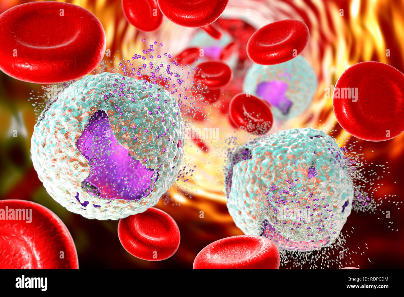 Leucemie aiguë lymphoblastique Banque de photographies et d’images à ...