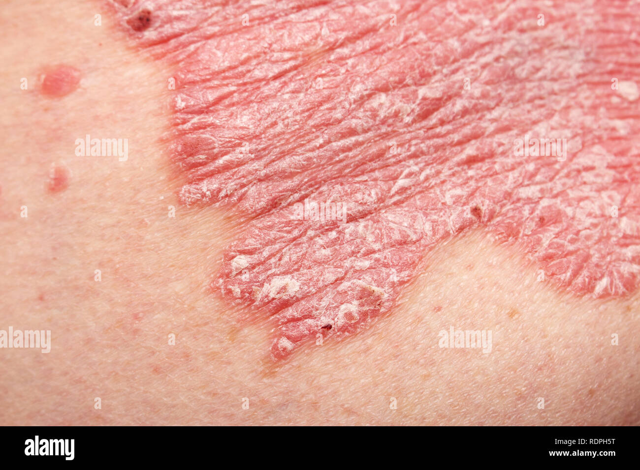 Détail Du Psoriasis Banque d'image et photos - Alamy