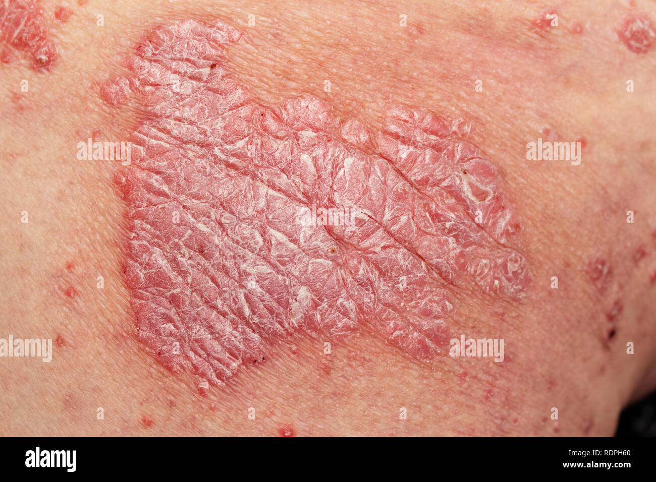 Psoriasis Vulgaris Banque d'image et photos - Alamy