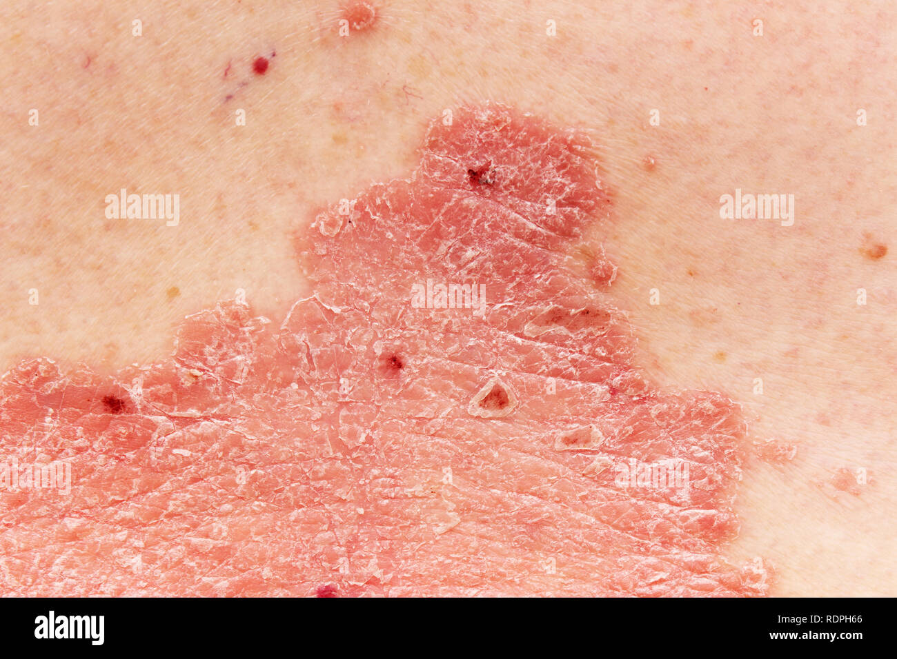 Psoriasis Pathologique Banque d'image et photos - Alamy