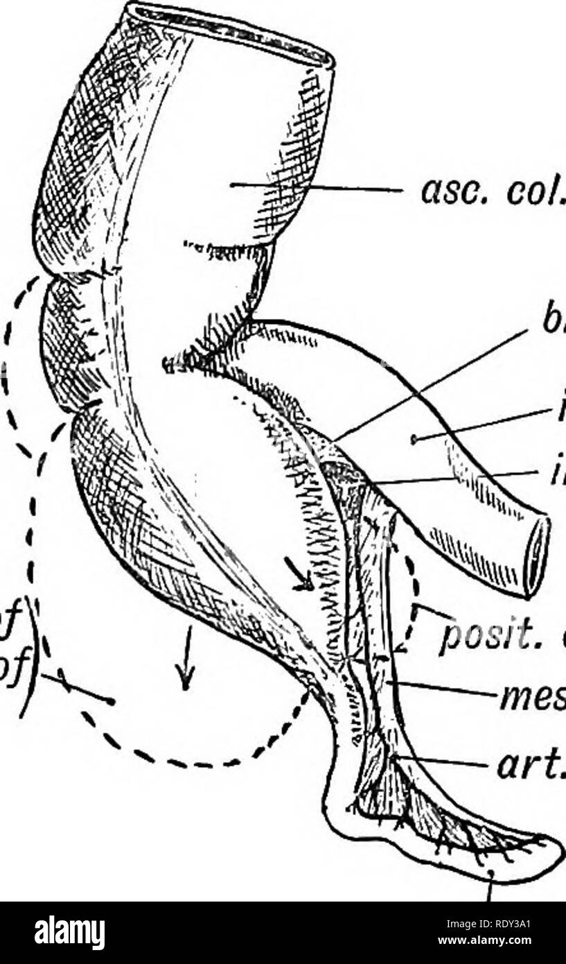 Sigmoid diverticulum Banque de photographies et d’images à haute ...