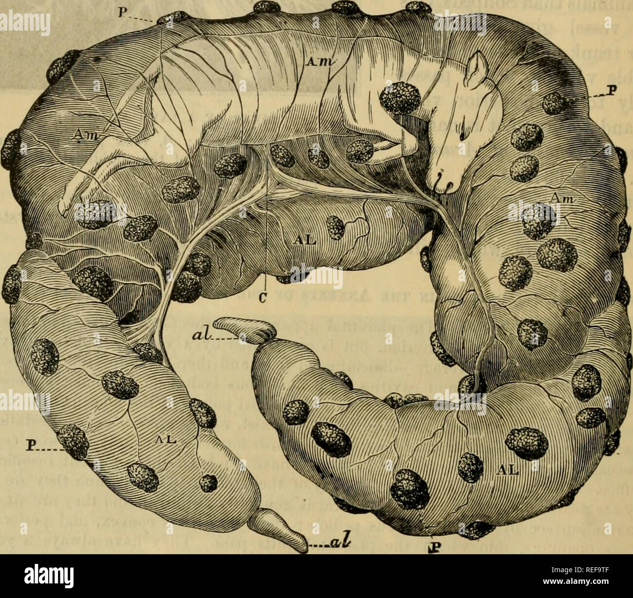 Diverticulum large intestine Banque de photographies et d’images à ...