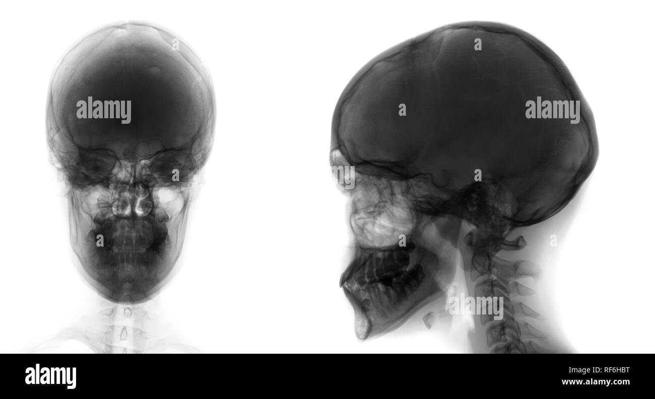 Ostéome ostéoïde Banque d'images noir et blanc - Alamy