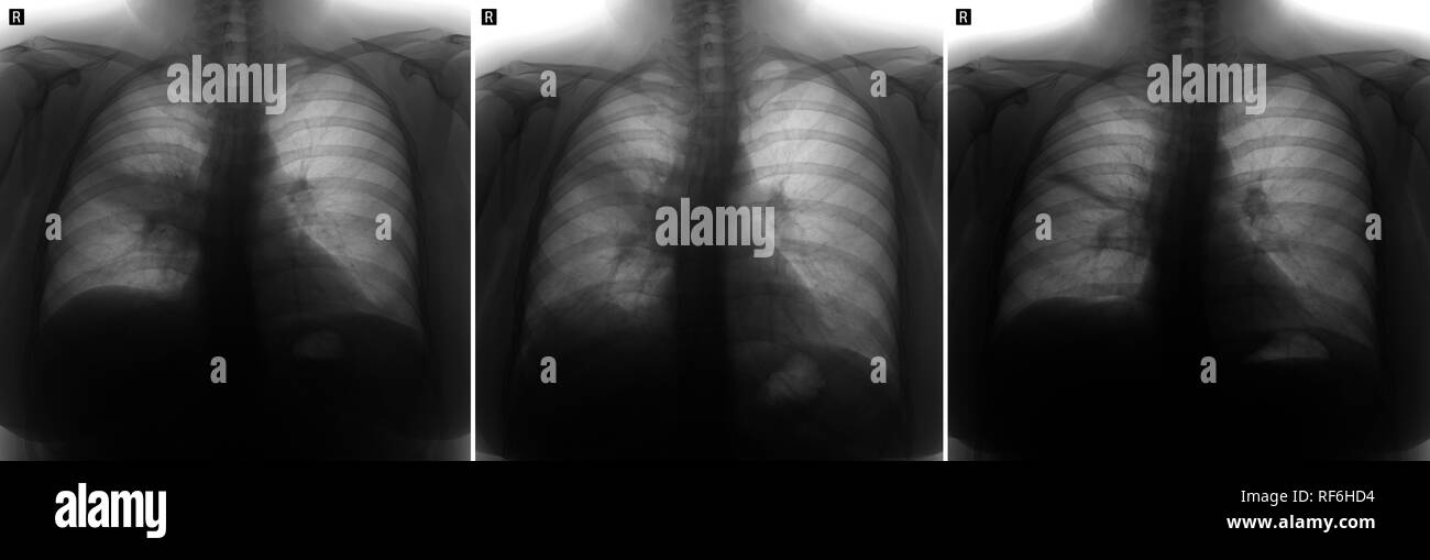 Radiografia de pulmon Banque d'images noir et blanc - Alamy