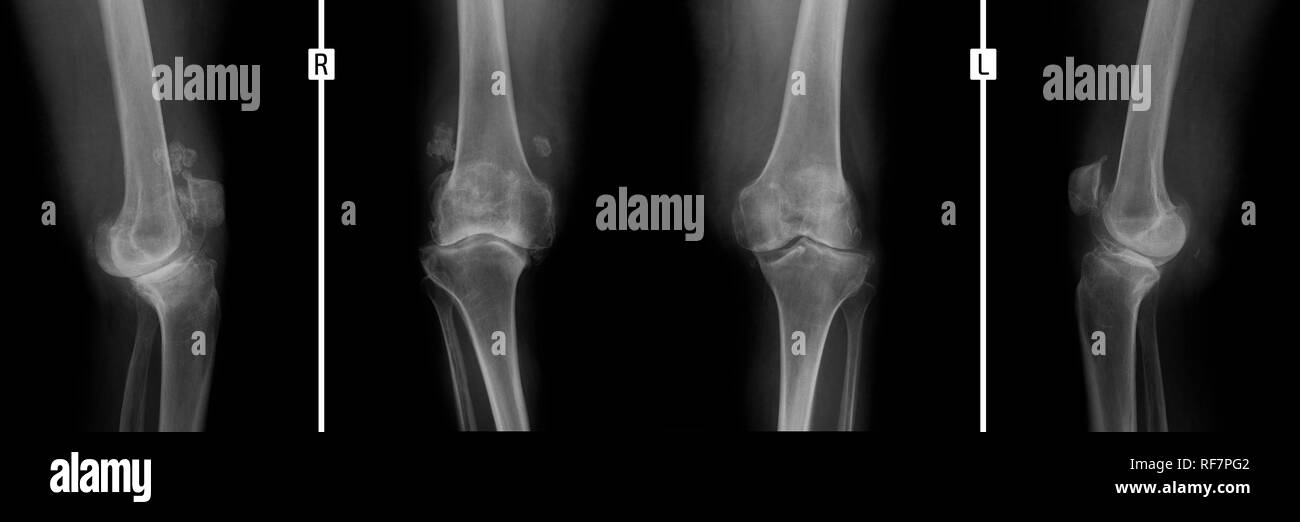 Arthrose genou et pieds Banque de photographies et d’images à haute ...