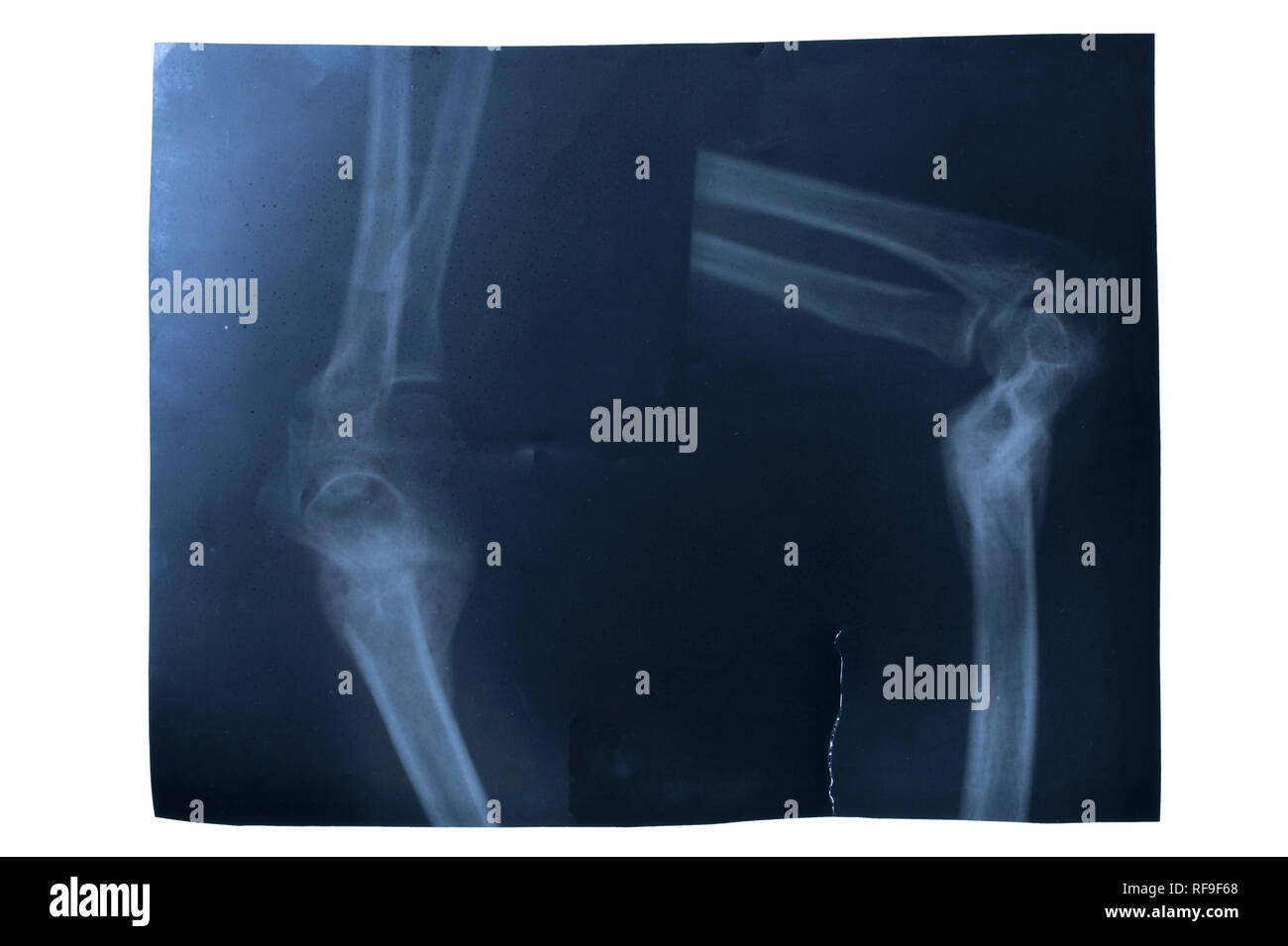 Anatomie de l'avant bras Banque de photographies et d’images à haute ...