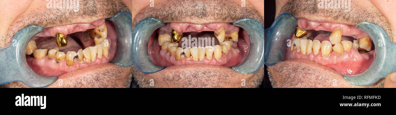 Rotten teeth woman Banque de photographies et d’images à haute ...