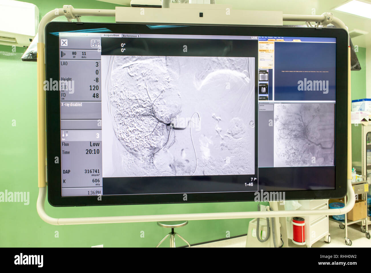 Salle d'angiographie numérique par soustraction, DSA lab, surveiller ...