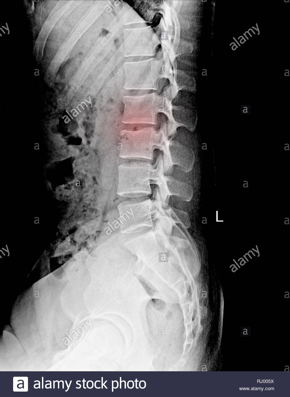 Fracture Dislocation Photos & Fracture Dislocation Images - Alamy