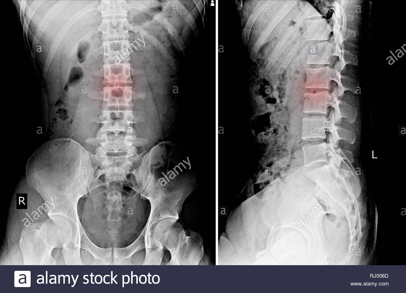 Fracture Dislocation Photos & Fracture Dislocation Images - Alamy