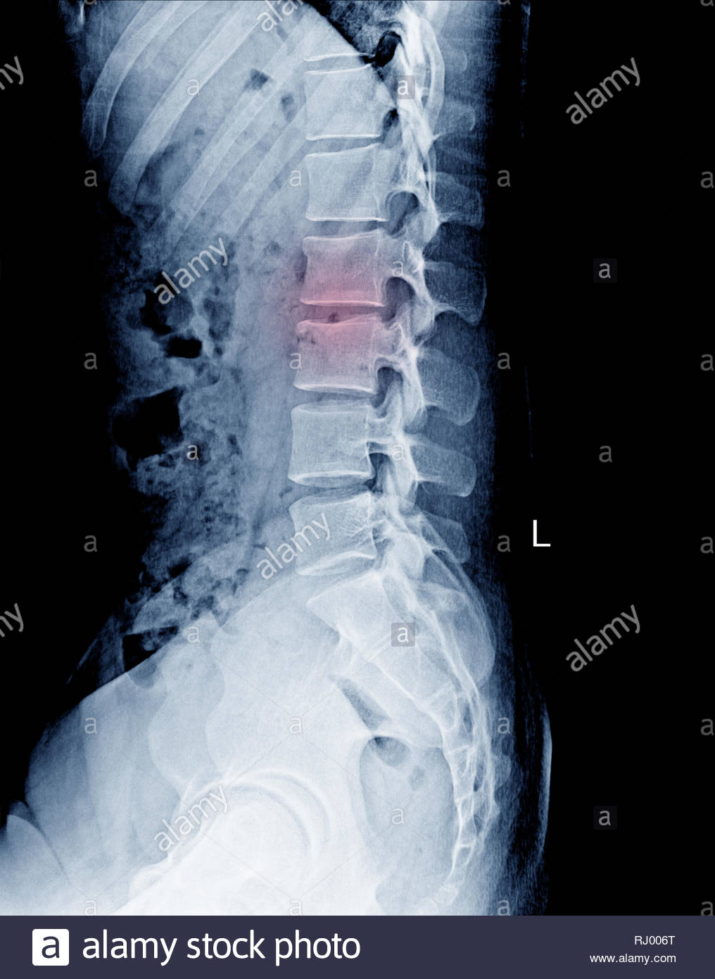 Fracture Dislocation Photos & Fracture Dislocation Images - Alamy