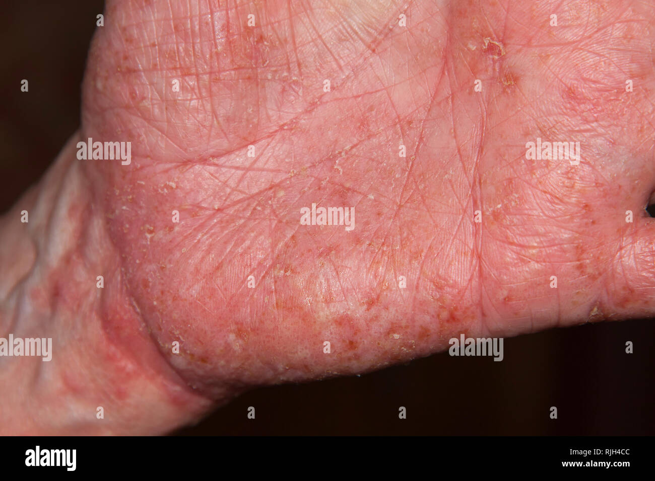 La Dermatite Atopiquel Banque d'image et photos - Page 2 - Alamy