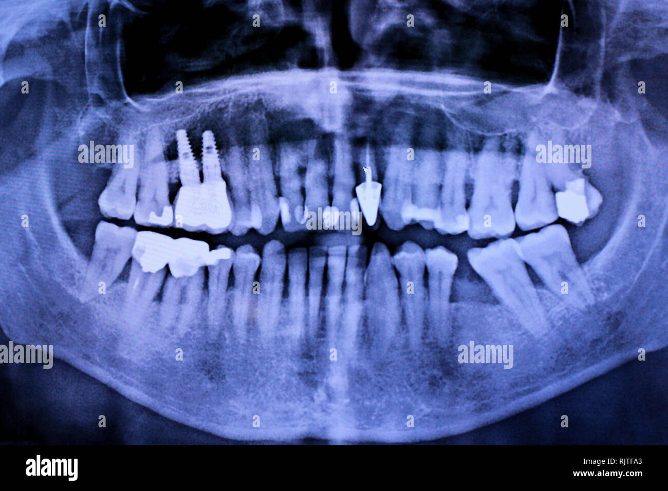 Radiographie Des Dents Banque d'image et photos - Alamy