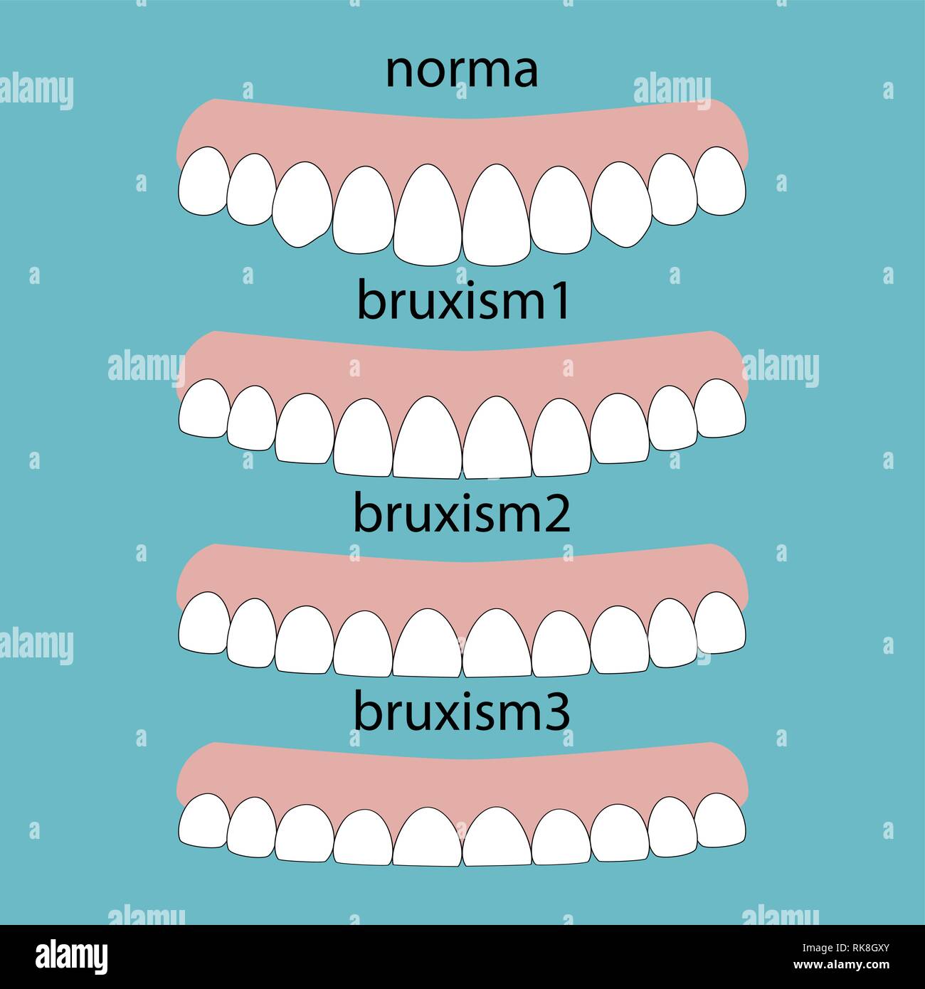 Types de dents erasability. La mise en page de l'attrition bruxisme ...