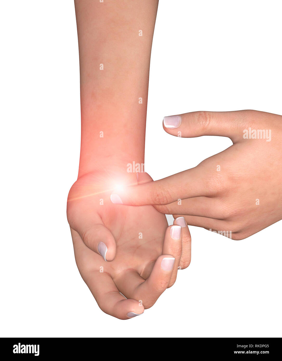 Le syndrome du canal carpien (SCC) est une maladie due à la compression ...