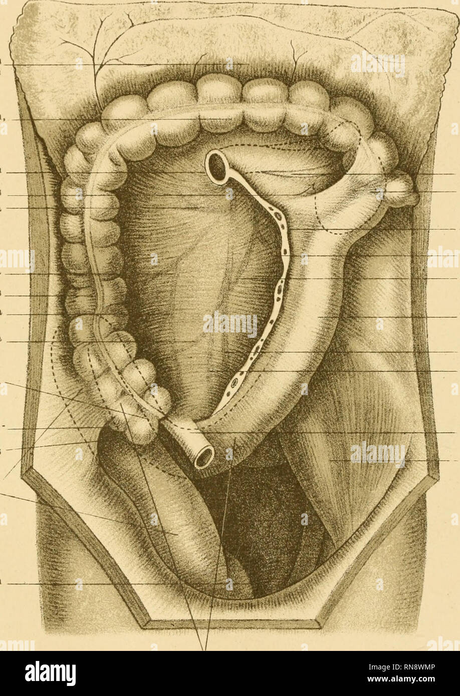 Côlon descendant Banque de photographies et d’images à haute résolution ...