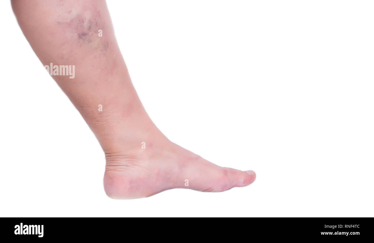 Veines de la jambe Banque d'images détourées - Alamy