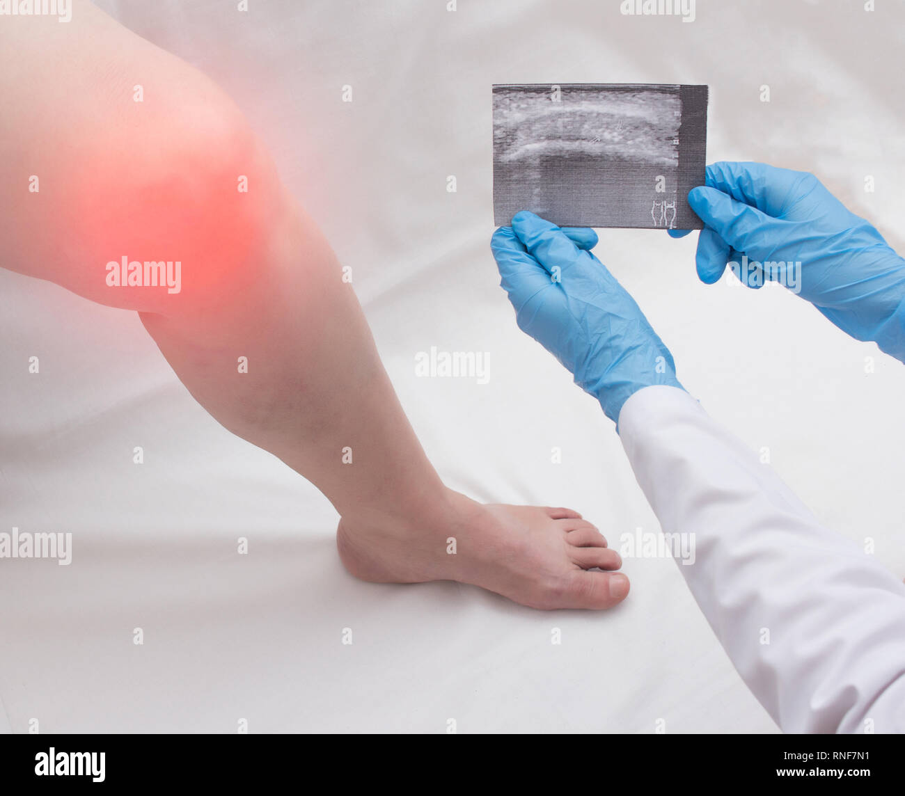 Bursite du genou Banque de photographies et d’images à haute résolution ...