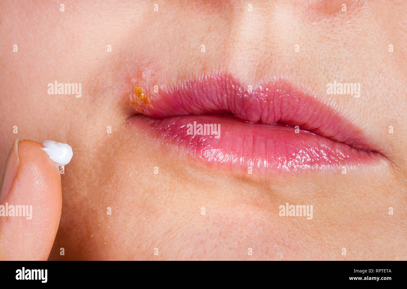 Maladie de la peau Banque de photographies et d’images à haute ...