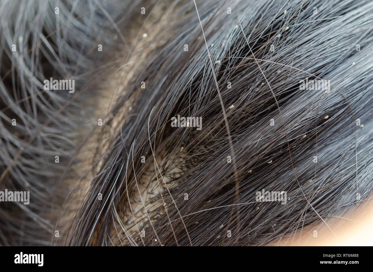 Oeufs de poux sur la tête de cheveux causes de démangeaisons Photo ...