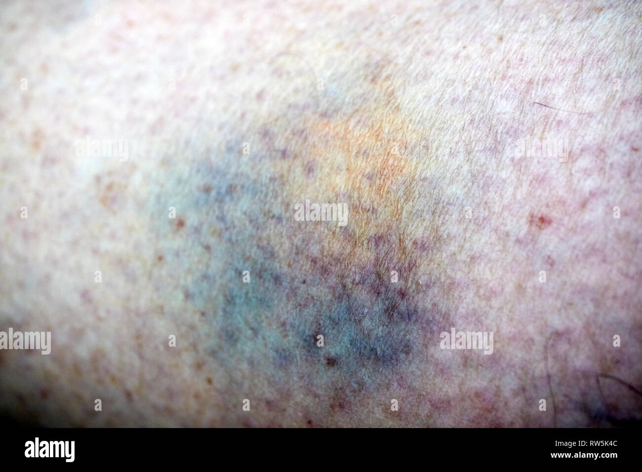 Ecchymose sur la peau Banque de photographies et d’images à haute ...