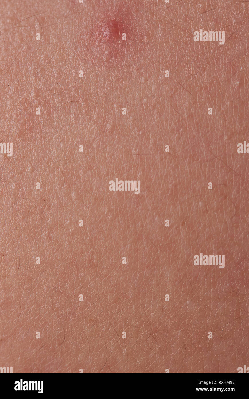 Tache rouge peau Banque de photographies et d’images à haute résolution ...