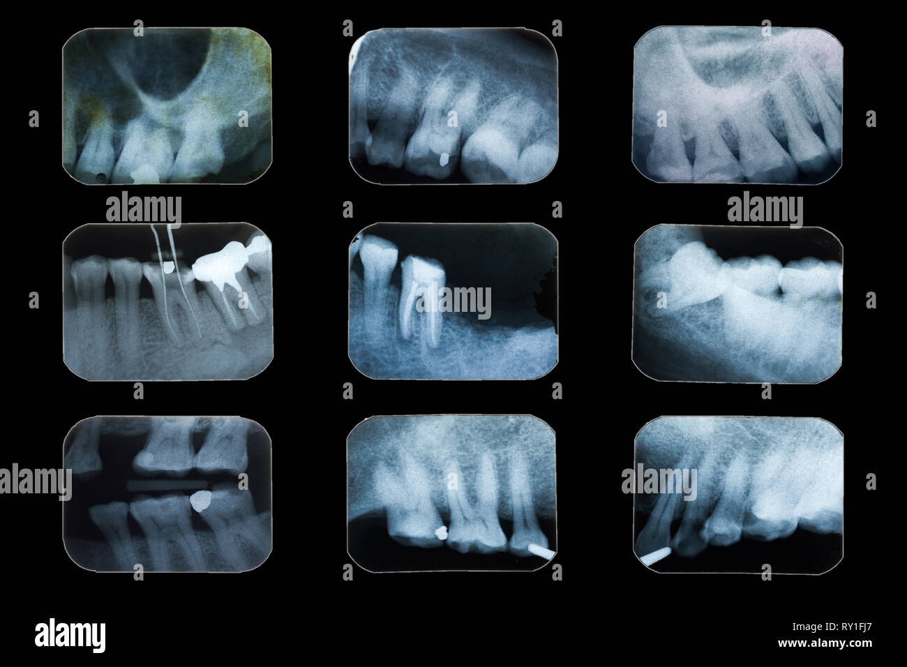 Radiographie dentaire Banque de photographies et d’images à haute ...