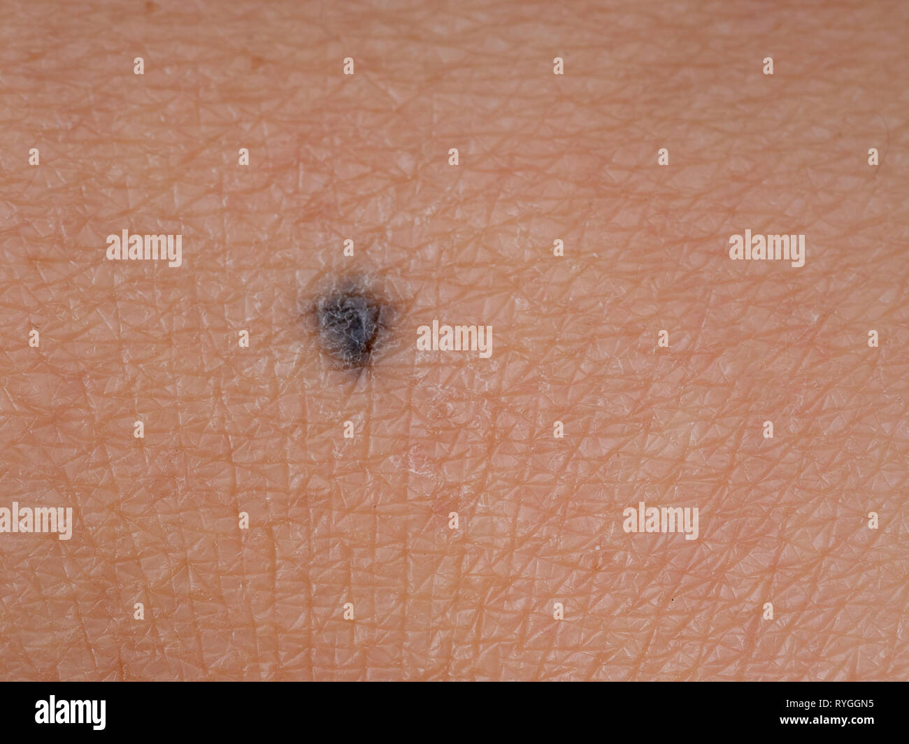 Dermal nevus Banque de photographies et d’images à haute résolution - Alamy