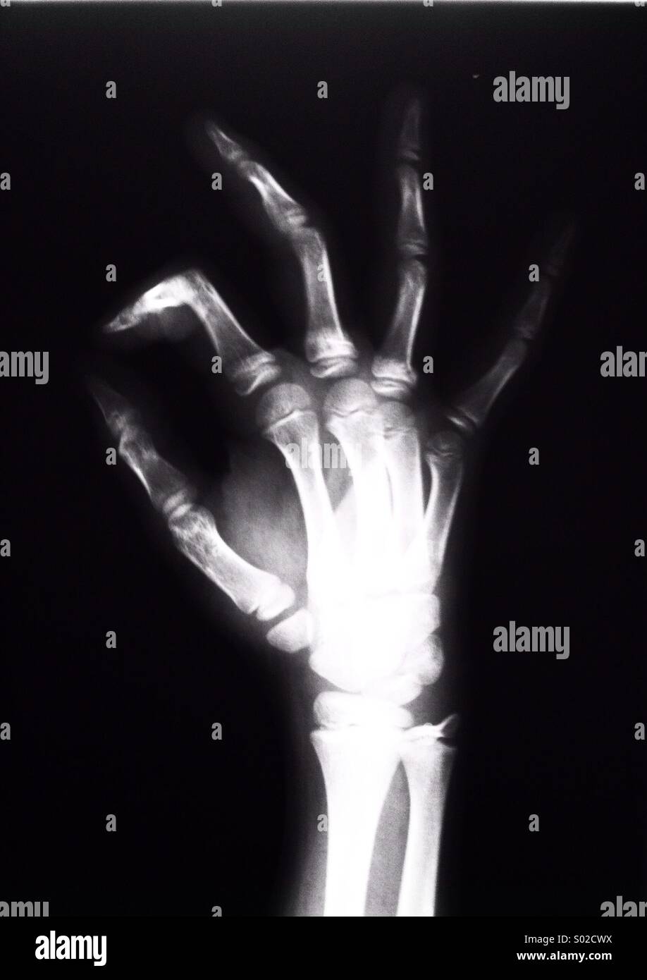 Radiographie de la main Banque de photographies et d’images à haute ...