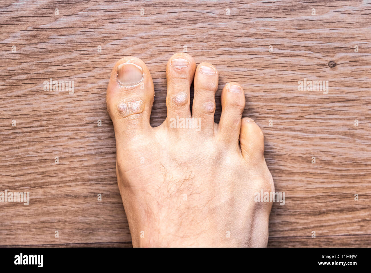 Pieds de l'homme aux pieds nus avec le psoriasis dermatite atopique sur ...
