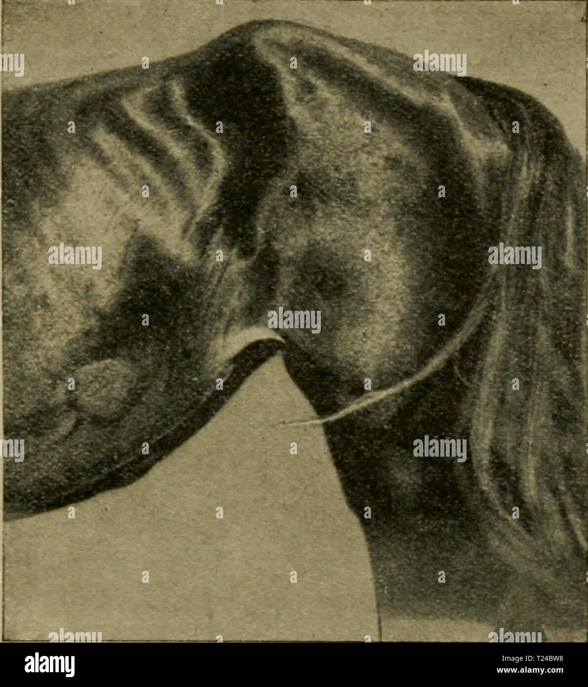 érythème polymorphe Banque de photographies et d’images à haute ...