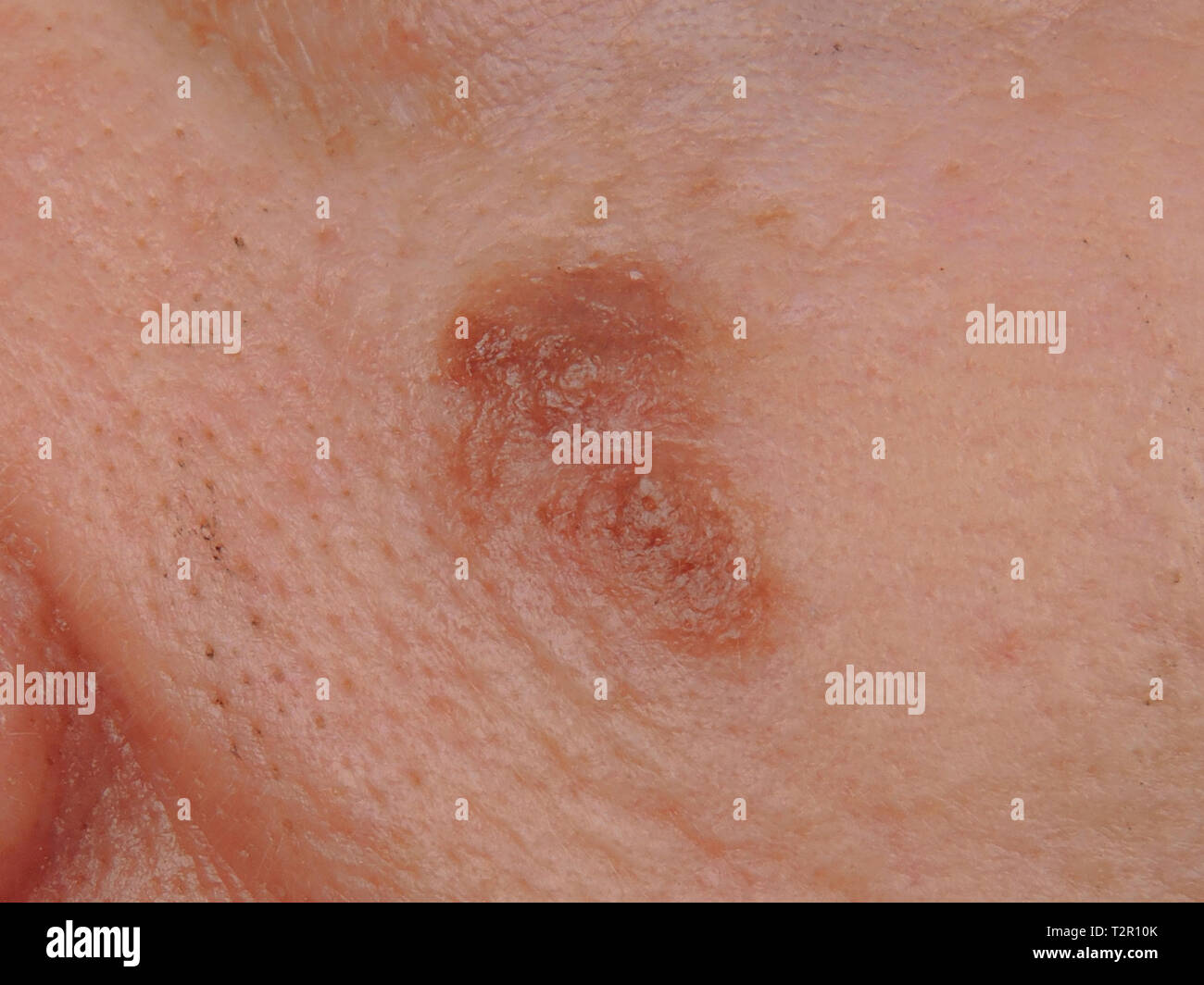 Mélanome de la peau Banque de photographies et d’images à haute résolution - Alamy