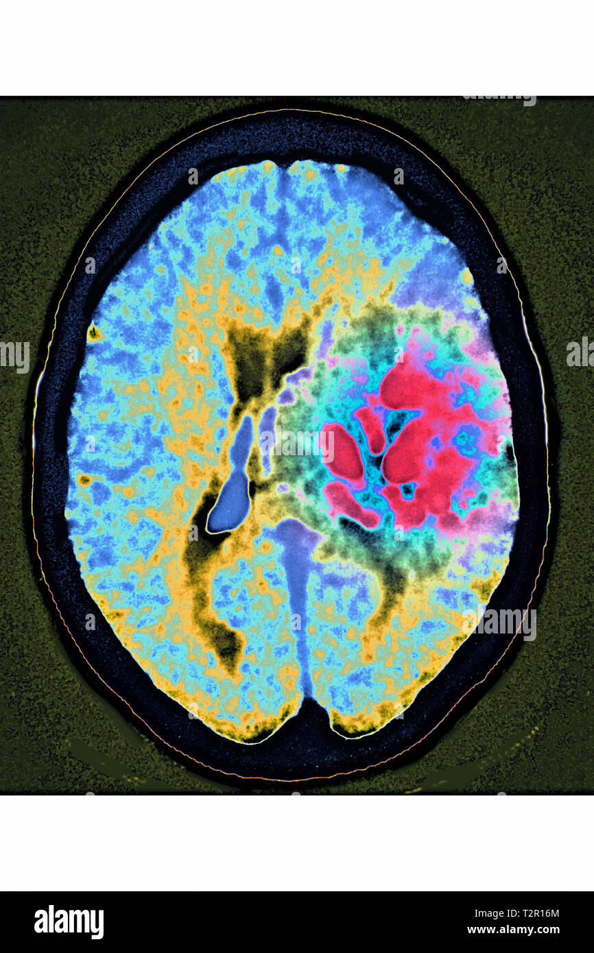 Malformation vasculaire du cerveau Banque de photographies et d’images ...